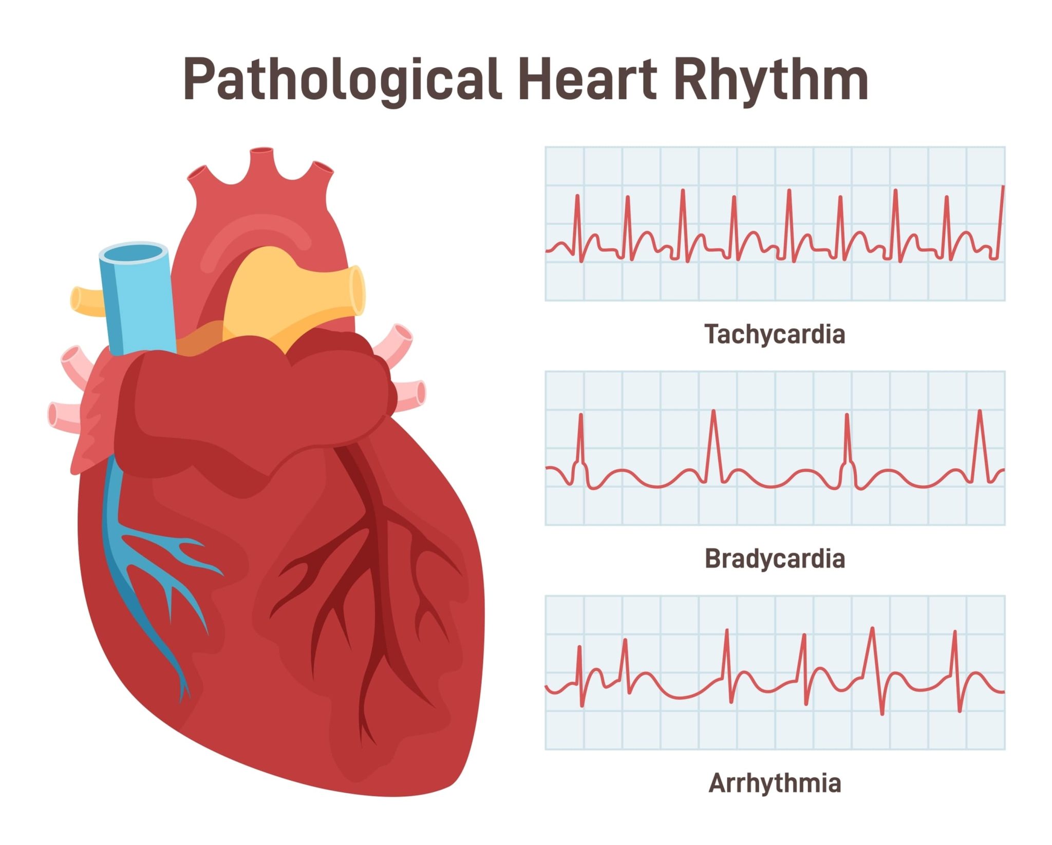 Heart Arrhythmia Treatment in Dubai | Arrhythmia Clinic
