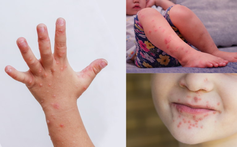 Hand, Foot, and Mouth Disease Clinic in Dubai | HFMD