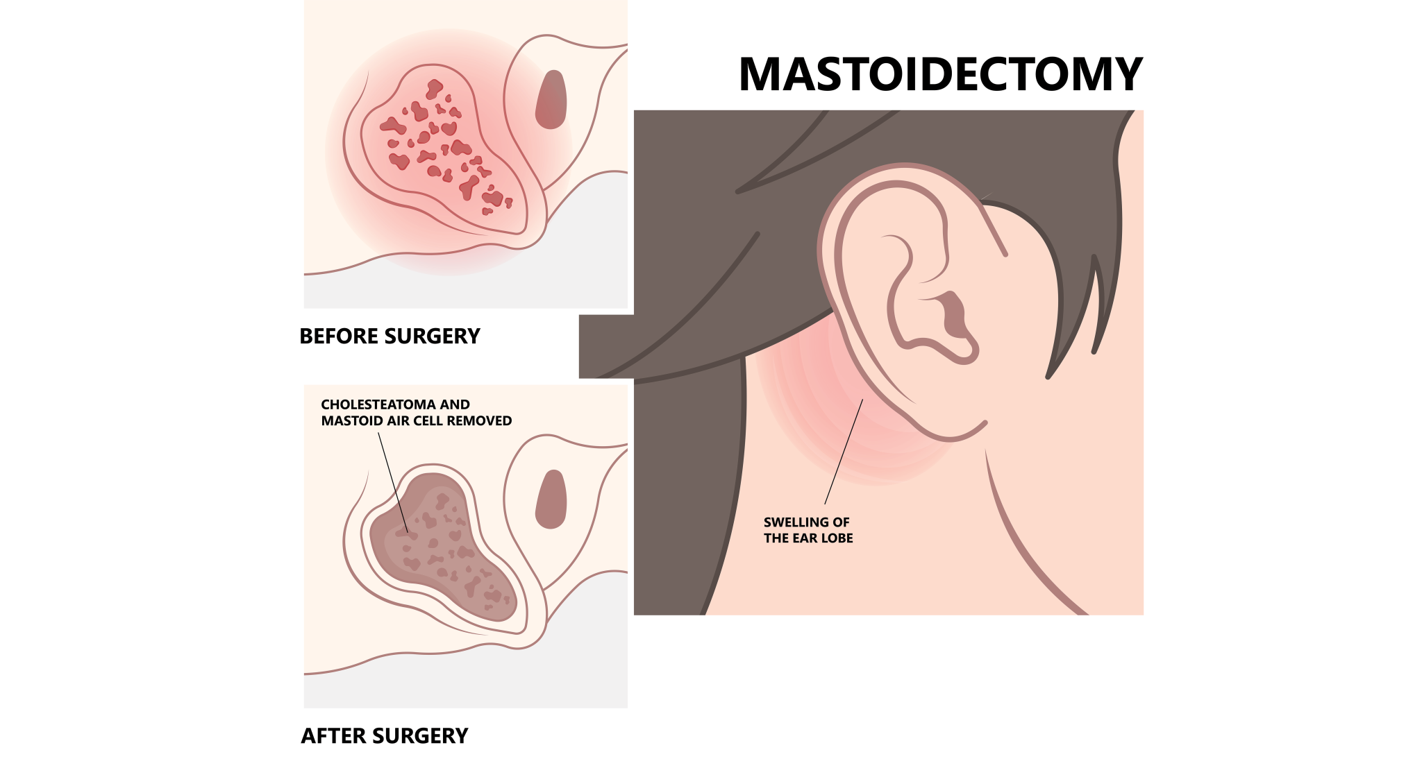Mastoidectomy Surgery in Dubai | Best ENT Surgeons in Dubai
