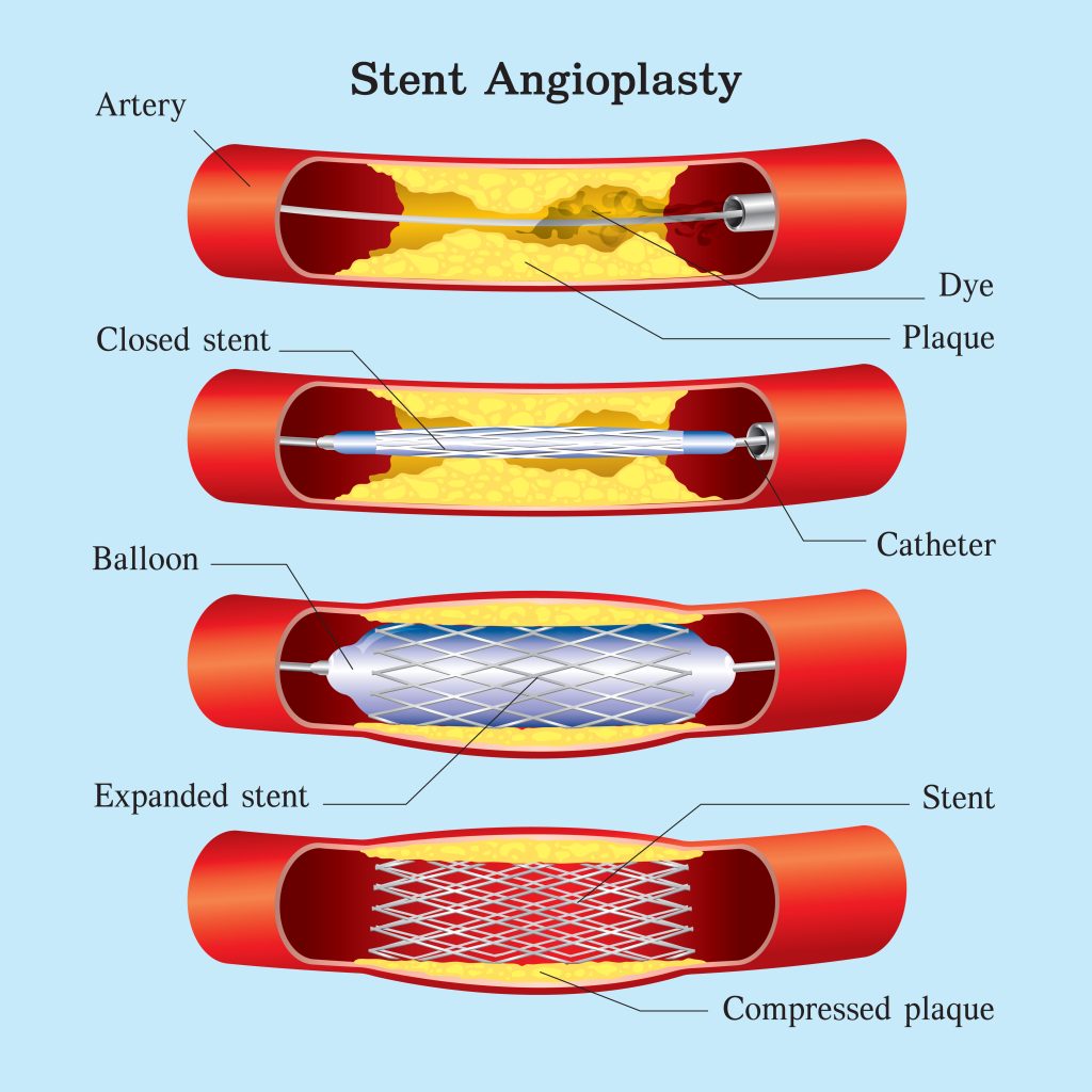 Angioplasty and stent procedure in Dubai, Emirates Hospitals