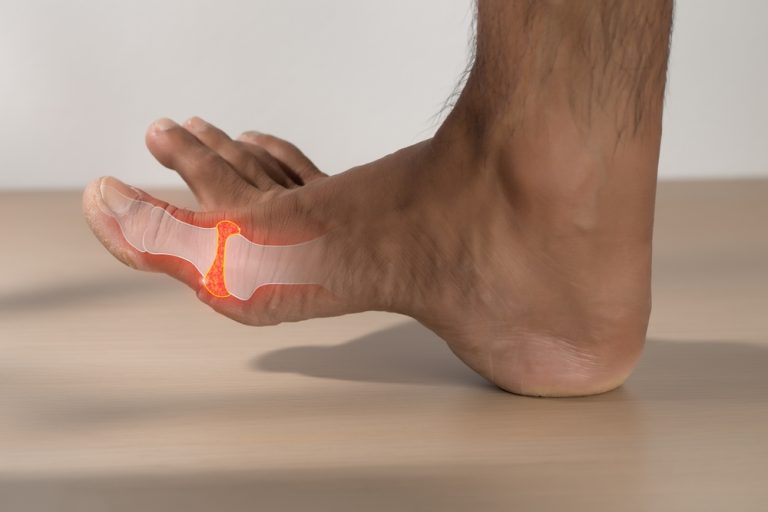 Gout Treatments in Dubai |Gout clinic near me-Causes of Gout