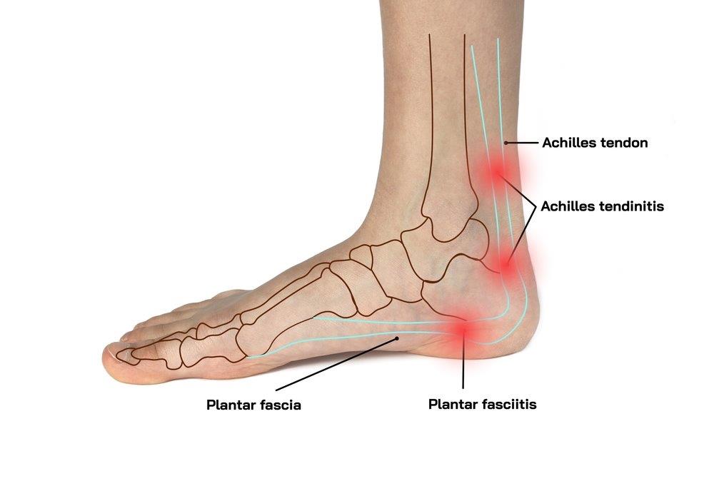 Tendinitis Treatment in Dubai | Best Tendinitis Doctors