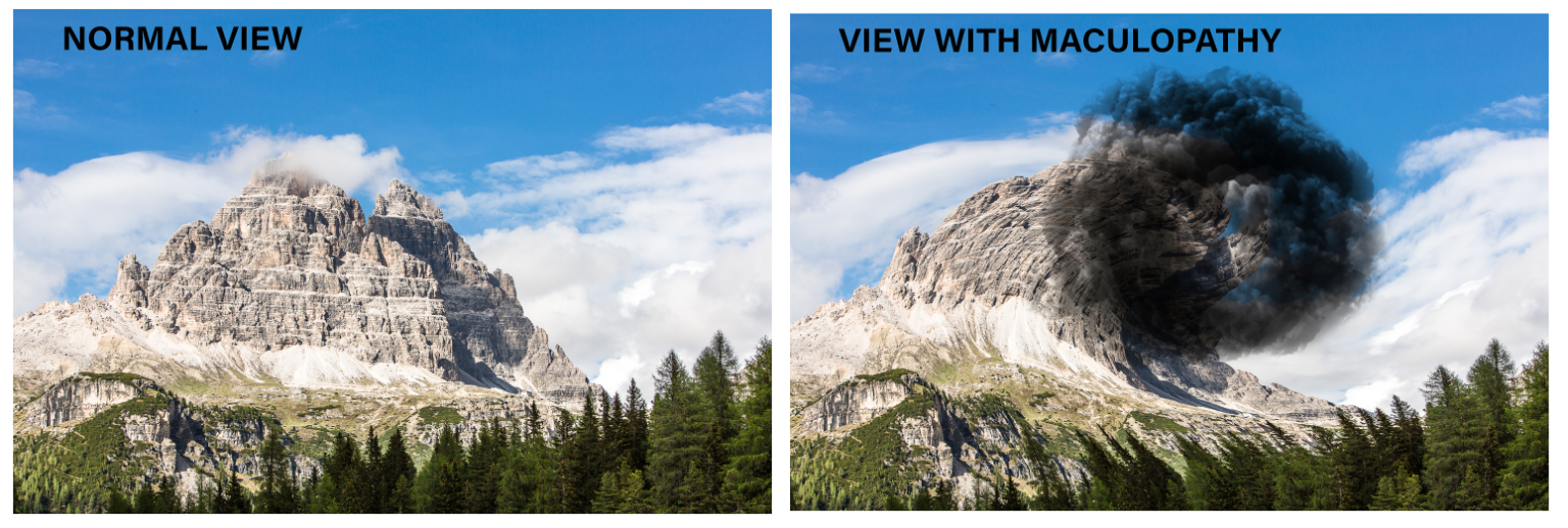 Advanced Diabetic Maculopathy Treatments in Dubai near me