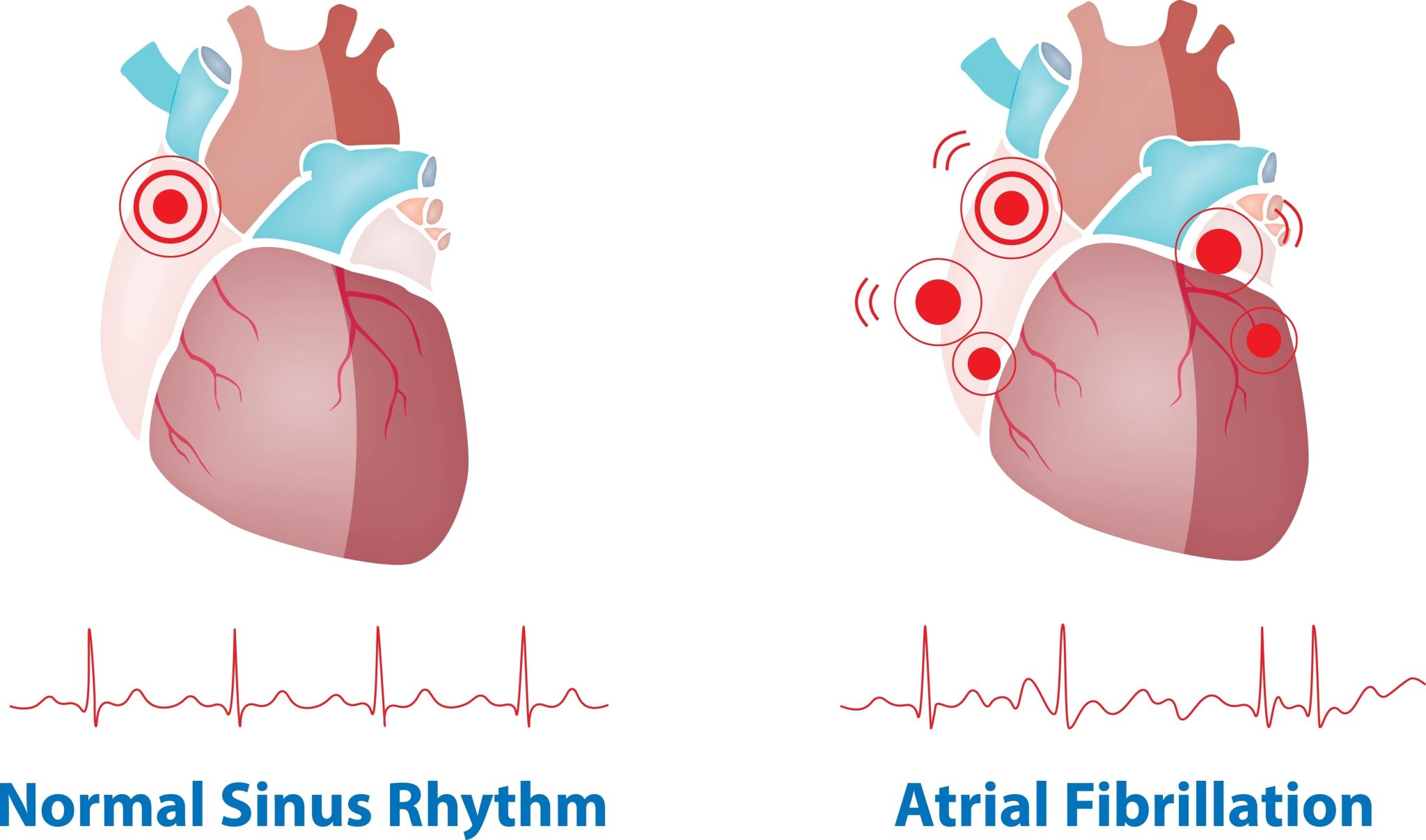 Atrial Fibrillation Treatment in Dubai | Afib Treatment UAE