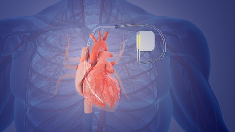 Best Pacemaker Surgery in Dubai |Best Pacemaker of the Heart