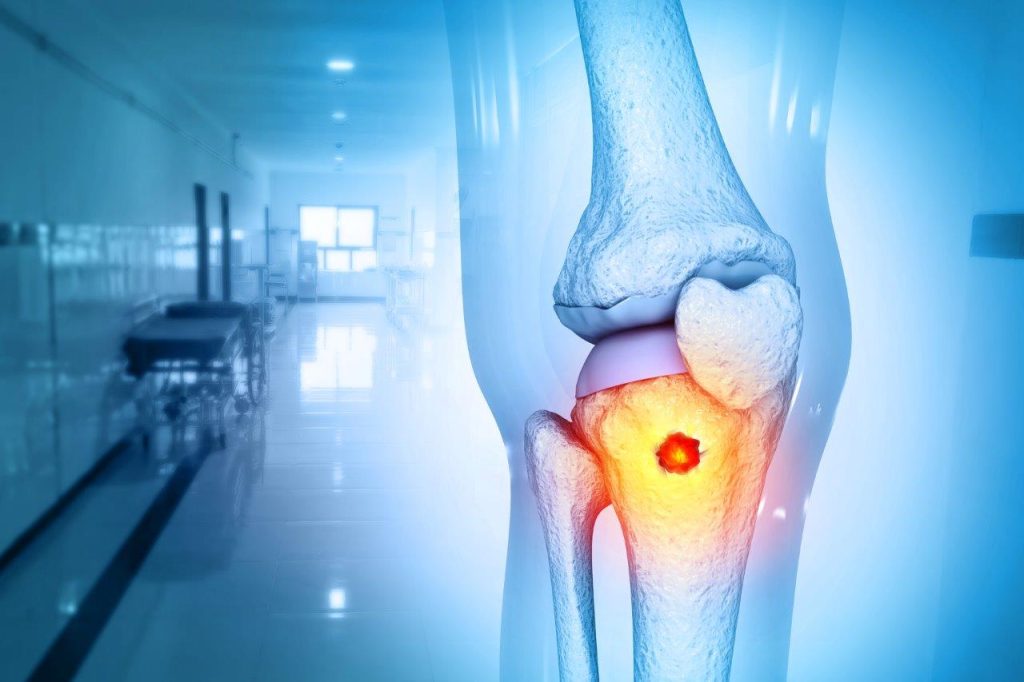 Sarcoma Treatment | Cancer Treatment in Dubai