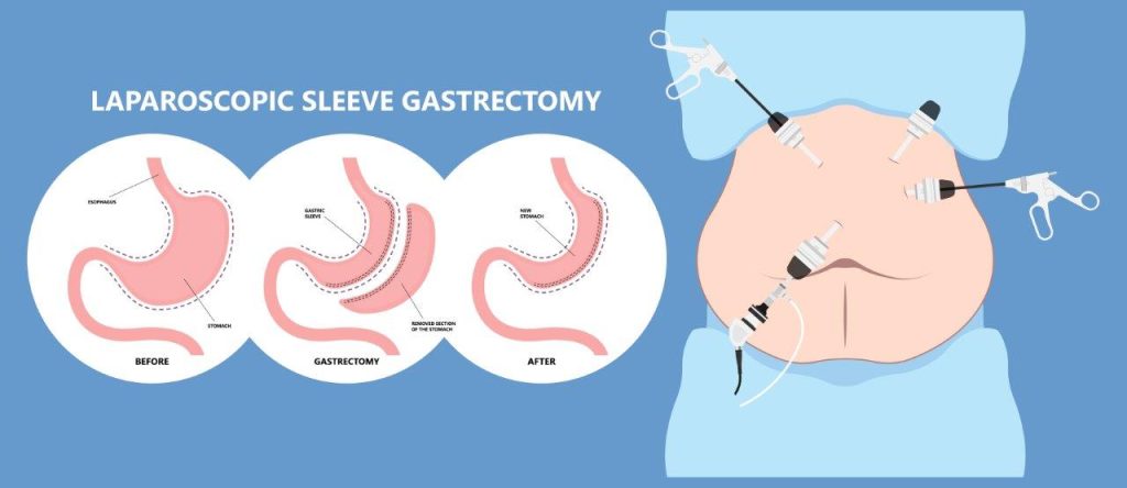 Laparoscopic Sleeve Gastrectomy | Sleeve Gastrectomy Dubai