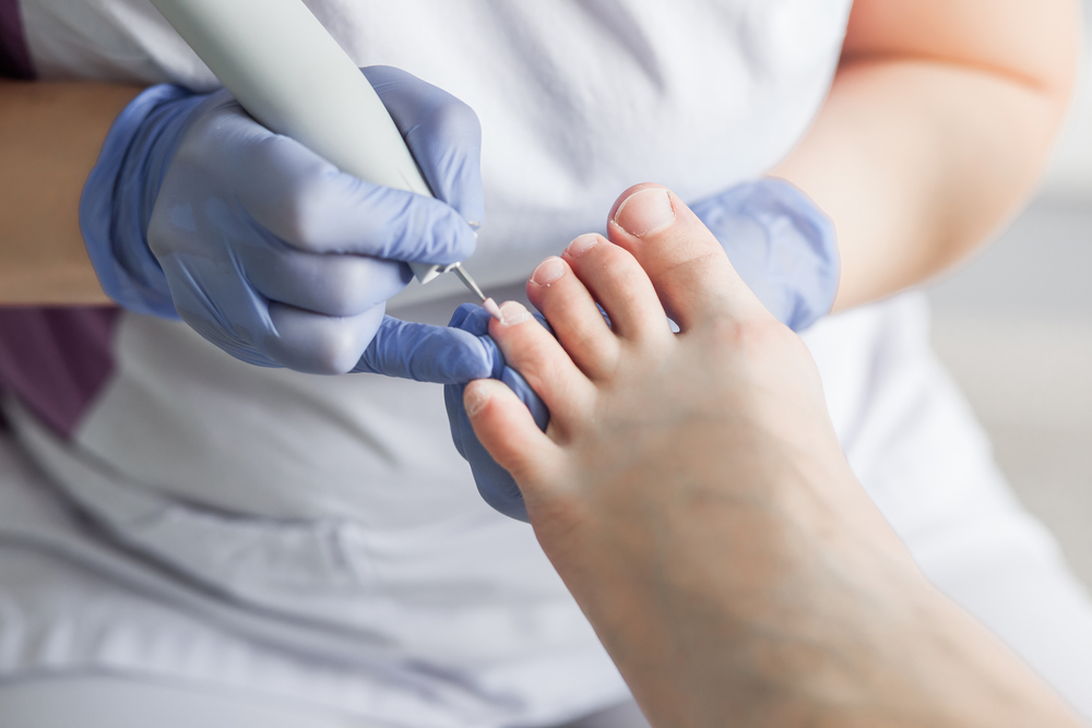 Ingrown Toenails Surgery in Dubai - Ingrown Toenails Removal