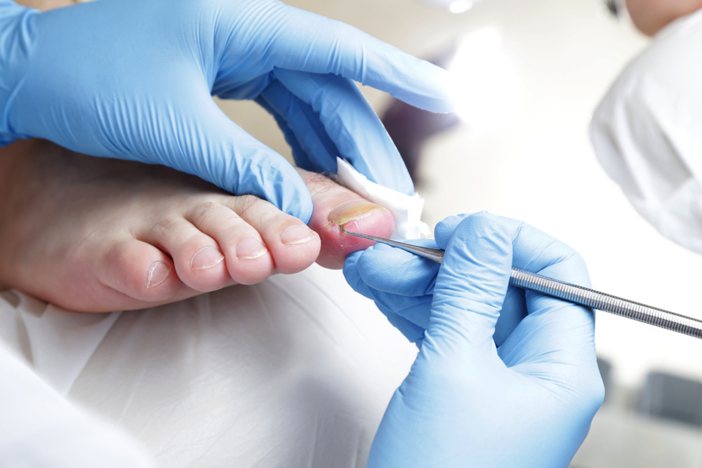 Ingrown Toenails Surgery in Dubai - Ingrown Toenails Removal
