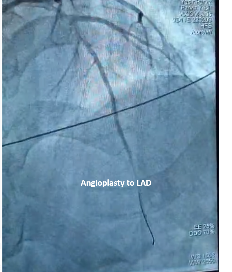 The Widowmaker – Severe blockage in LAD artery - Emirates Hospitals