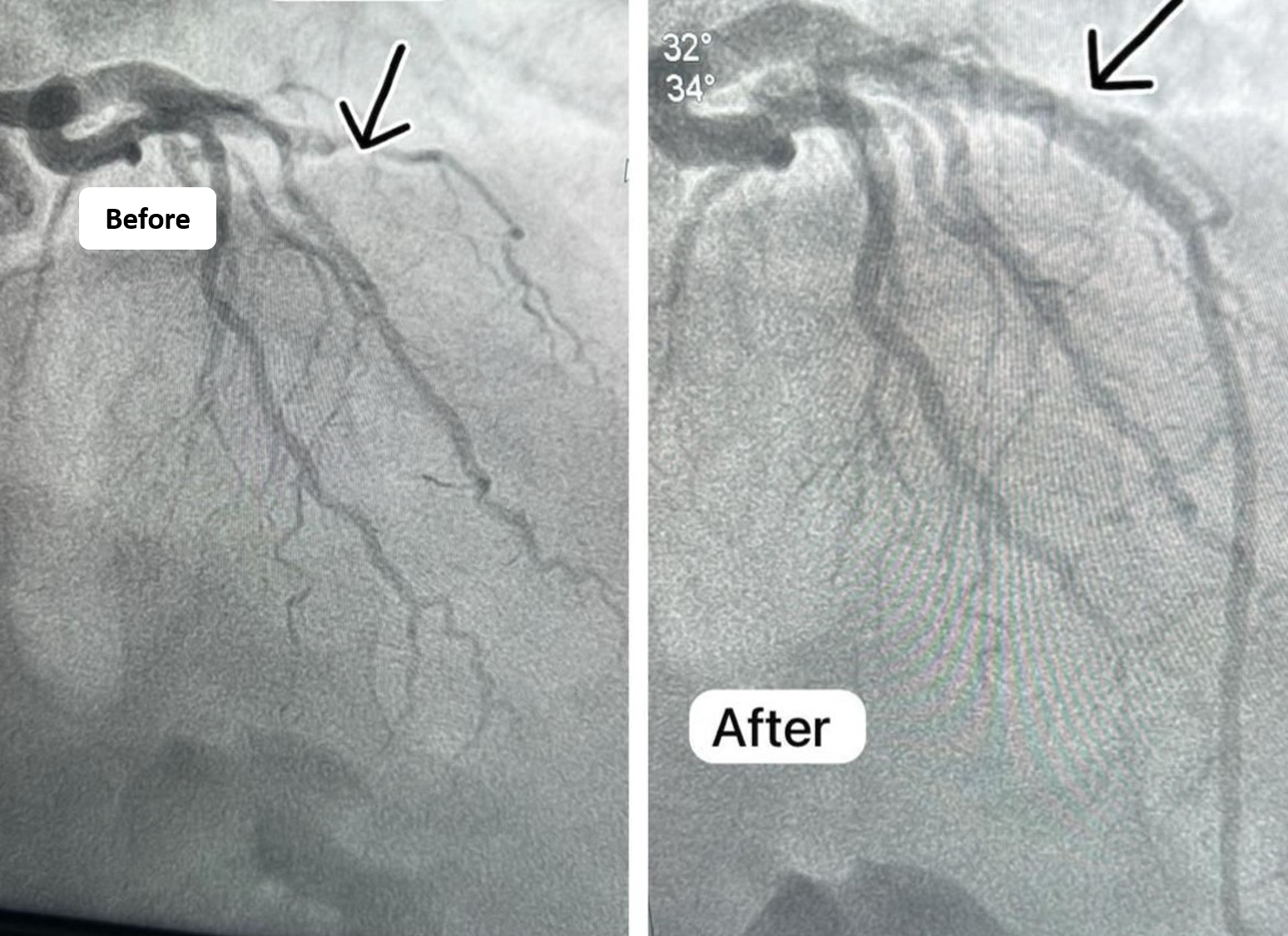 Chronic Total Occlusion of the Coronary Artery - Emirates Hospitals
