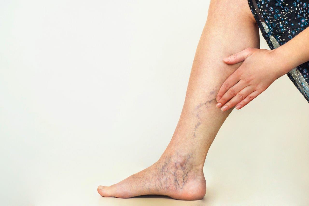Chronic Venous Insufficiency | Emirates Hospitals Group